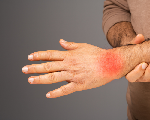 Understanding Rheumatoid Arthritis | Skin And Cancer Institute